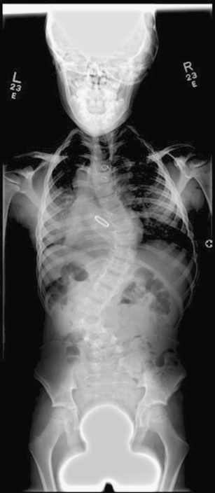 Loeys-Dietz syndrome: cardiovascular, neuroradiological and ...
