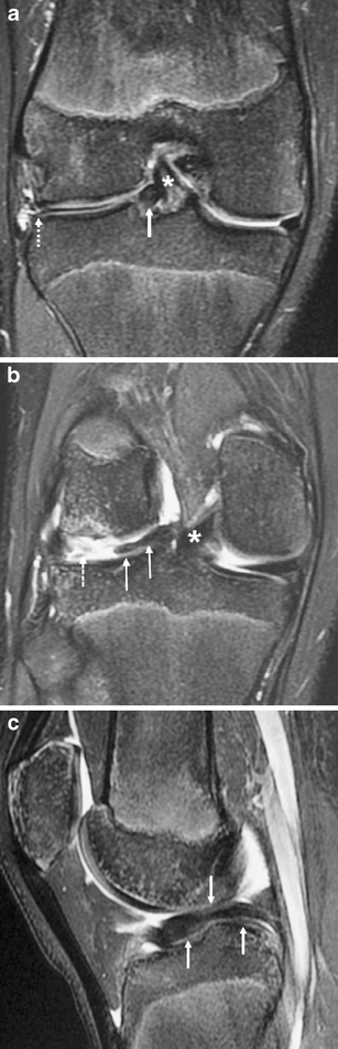 MRI of displaced meniscal fragments | SpringerLink