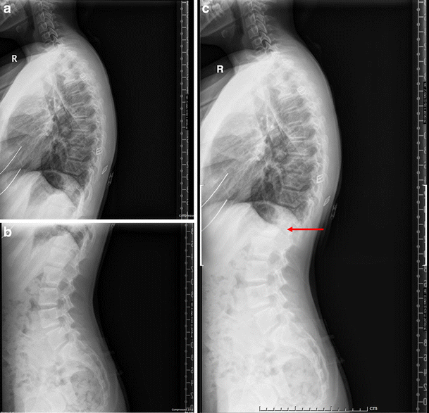 Diagnostic errors from digital stitching of scoliosis images – the ...