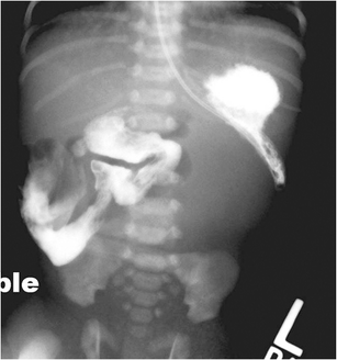 Imaging findings in megacystis-microcolon-intestinal hypoperistalsis ...