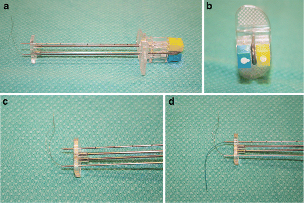 Two parallel needles with snare gastropexy device during gastrostomy in ...