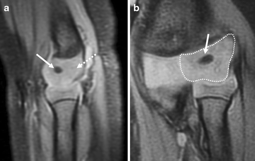 MR imaging of capitellar ossification: a study in children of different ...