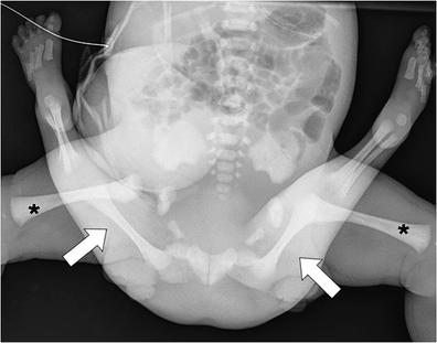 In utero and postnatal imaging findings of parasitic conjoined twins ...
