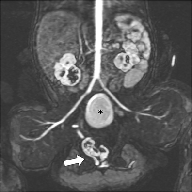 In utero and postnatal imaging findings of parasitic conjoined twins ...