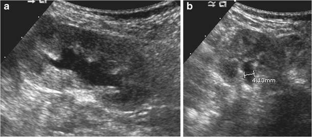 Characterizing upper urinary tract dilation on ultrasound: a survey of ...