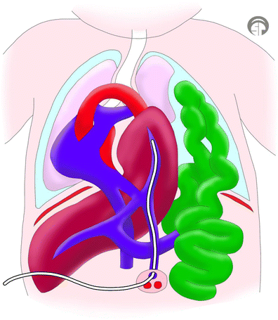 Umbilical venous catheter malposition and errors in interpretation in ...
