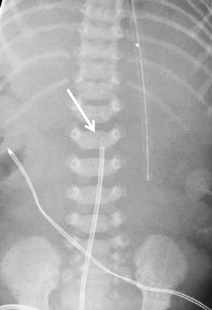 Umbilical venous catheter malposition and errors in interpretation in ...