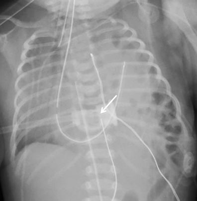 Umbilical venous catheter malposition and errors in interpretation in ...