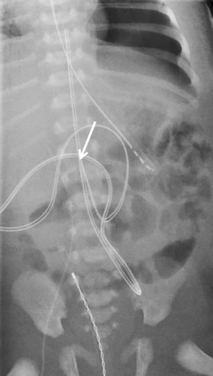 Umbilical venous catheter malposition and errors in interpretation in ...