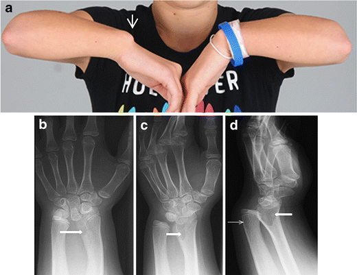 Madelung deformity and Madelung-type deformities: a review of the ...