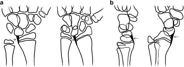 Madelung deformity and Madelung-type deformities: a review of the ...