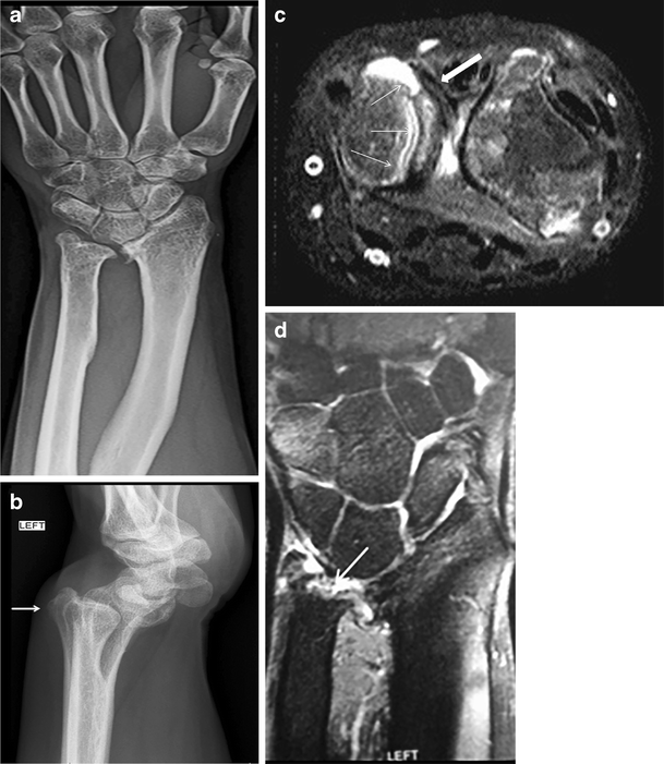 Madelung deformity and Madelung-type deformities: a review of the ...