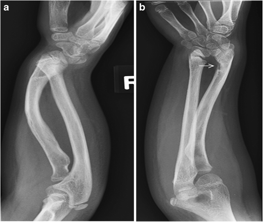 Madelung deformity and Madelung-type deformities: a review of the ...