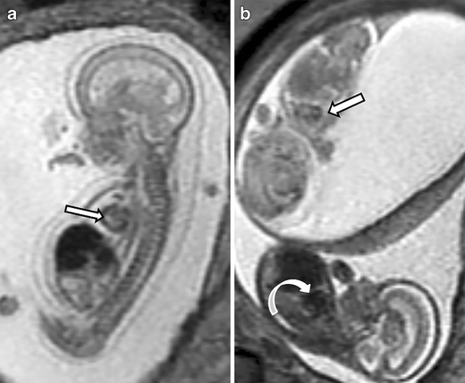 Guidelines for scanning twins and triplets with US and MRI | SpringerLink