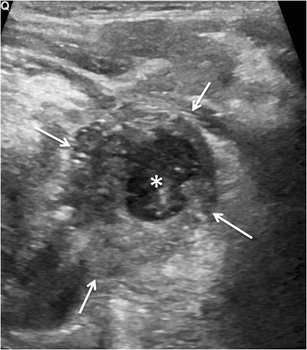 Tonsil ultrasound: technical approach and spectrum of pediatric ...