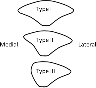 Imaging assessment of patellar instability and its treatment in ...