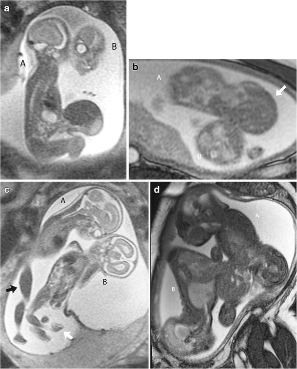 Fetal Anterior Abdominal Wall Defects Prenatal Imaging By Magnetic