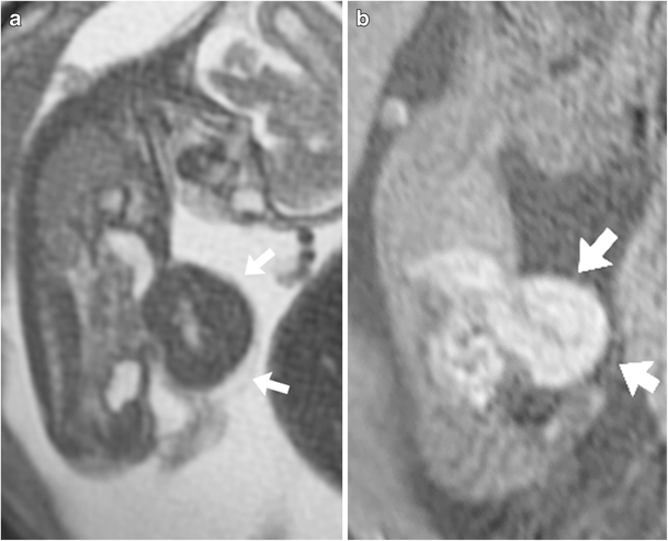 Fetal Anterior Abdominal Wall Defects Prenatal Imaging By Magnetic