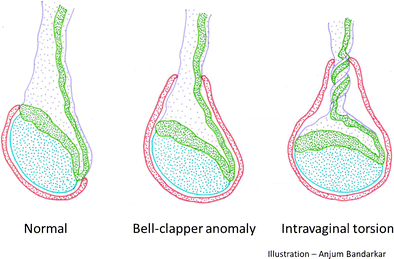 Testicular torsion with preserved flow: key sonographic features and ...