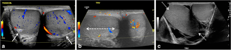 Testicular torsion with preserved flow: key sonographic features and ...