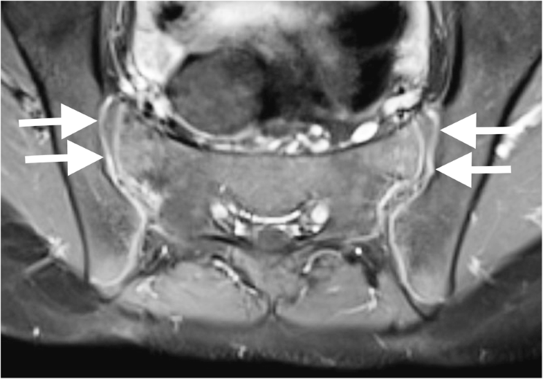 Magnetic resonance imaging of sacroiliitis in children: frequency of ...