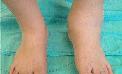 Tenosynovial lipoma arborescens of the ankle in a child | SpringerLink