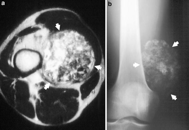 Benign fatty tumors: classification, clinical course, imaging ...