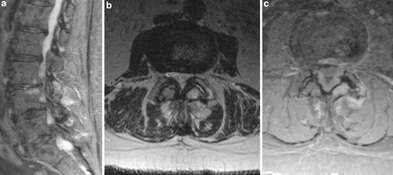 The prevalence of lumbar facet joint edema in patients with low back ...