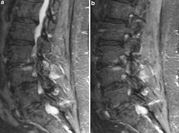 The prevalence of lumbar facet joint edema in patients with low back ...