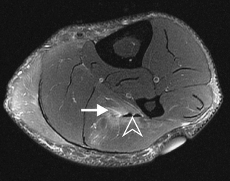 Magnetic resonance imaging findings of injuries to the calf muscle ...