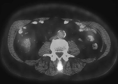 Baastrup’s disease (kissing spine) demonstrated by FDG PET/CT ...