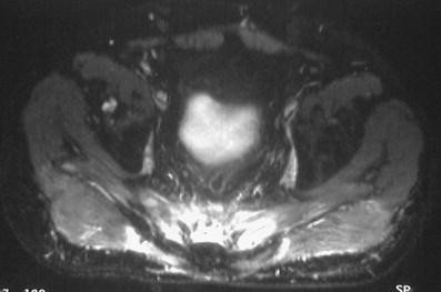 MRI appearance of muscle denervation | SpringerLink