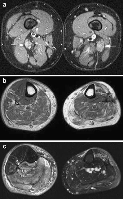MRI appearance of muscle denervation | SpringerLink