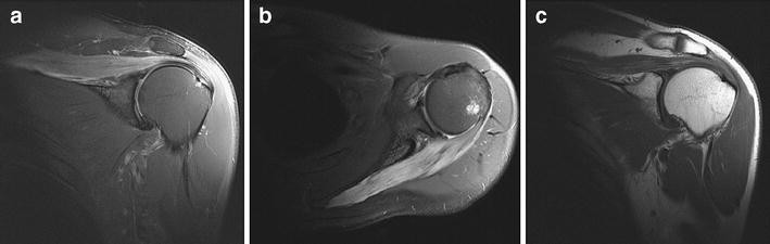 MRI appearance of muscle denervation | SpringerLink