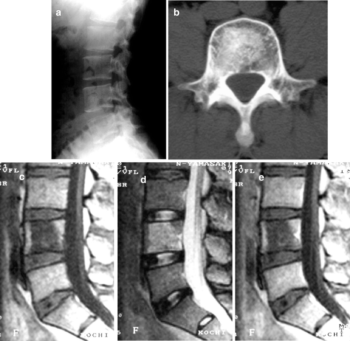 Distinguishing benign notochordal cell tumors from vertebral chordoma ...