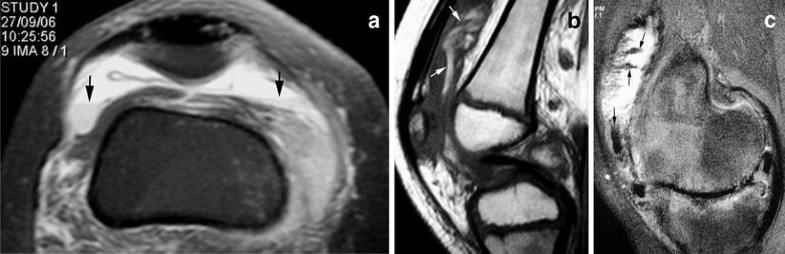 Synovial recesses of the knee: MR imaging review of anatomical and ...