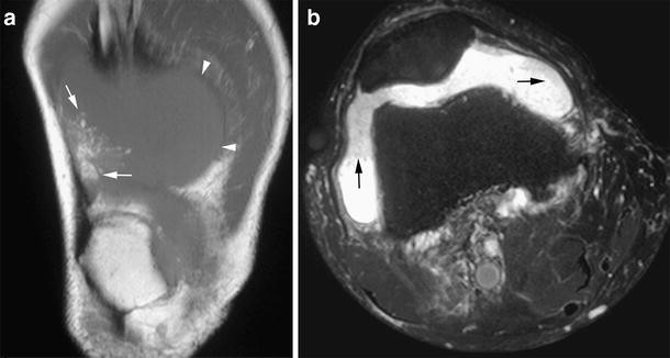 Synovial recesses of the knee: MR imaging review of anatomical and ...
