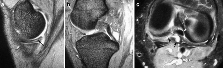 Synovial recesses of the knee: MR imaging review of anatomical and ...