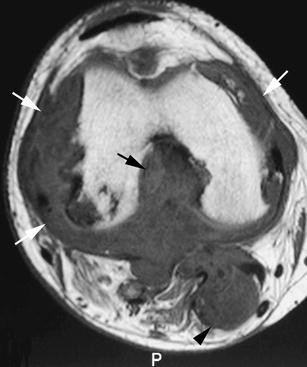 Synovial recesses of the knee: MR imaging review of anatomical and ...