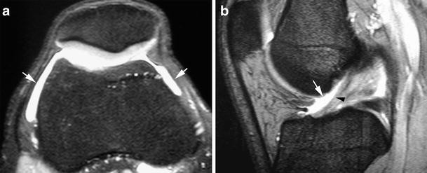 Synovial recesses of the knee: MR imaging review of anatomical and ...