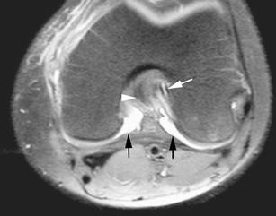Synovial recesses of the knee: MR imaging review of anatomical and ...