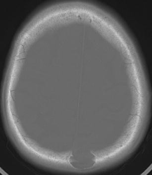 Imaging pattern of calvarial lesions in adults | SpringerLink