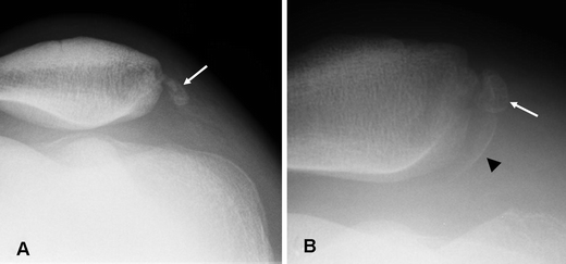 The “sliver sign”: a specific radiographic sign of acute lateral ...