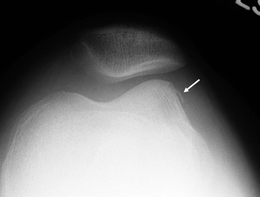 The “sliver sign”: a specific radiographic sign of acute lateral ...