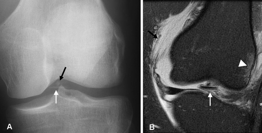 The “sliver sign”: a specific radiographic sign of acute lateral ...