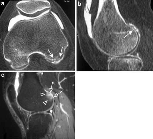 Subchondral impaction fractures of the non-weight-bearing portion of ...