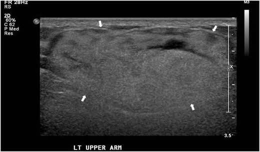 Encapsulated fat necrosis mimicking subcutaneous liposarcoma ...