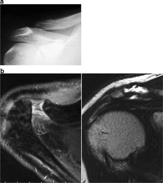 MRI of subchondral fractures: a review | SpringerLink