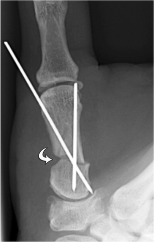 Imaging and management of thumb carpometacarpal joint osteoarthritis ...