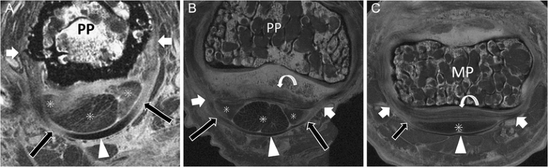 Magnetic resonance imaging of the pulleys of the flexor tendons of the ...